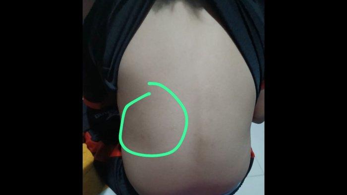 Siswa SD di Bekasi Diduga Jadi Korban Perundungan, Alami Pergeseran Tulang dan Memar - Go Bekasi